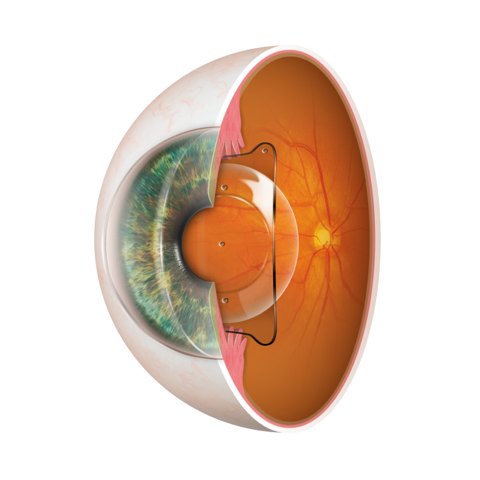 Permanent Contact Lenses Are Changing the Way We See - EuroEyes