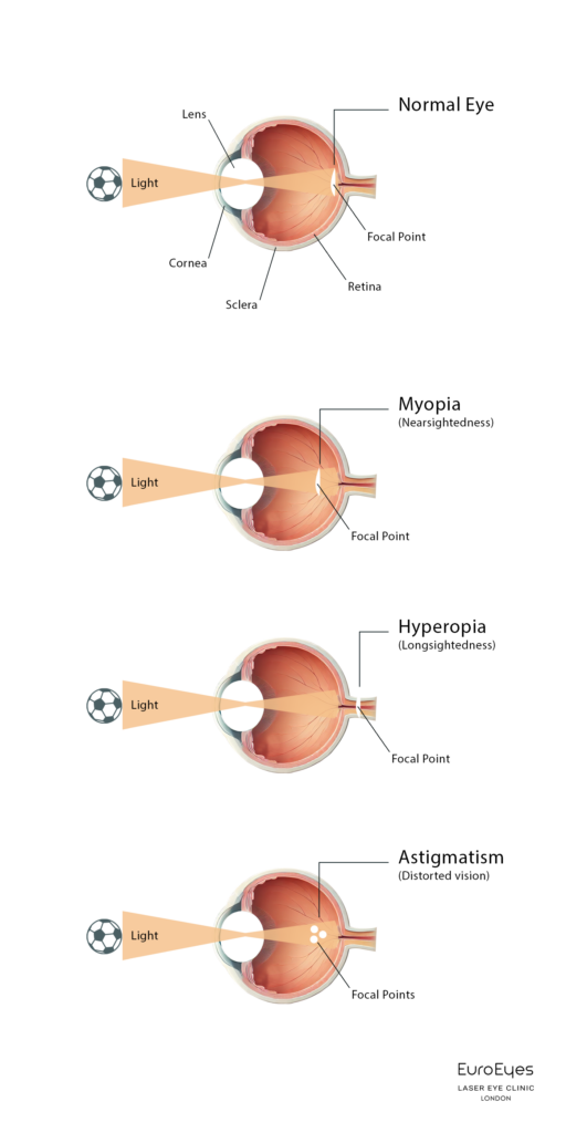 Short Eyesight And Nearsightedness! What Myopia Means For Your Eye Health